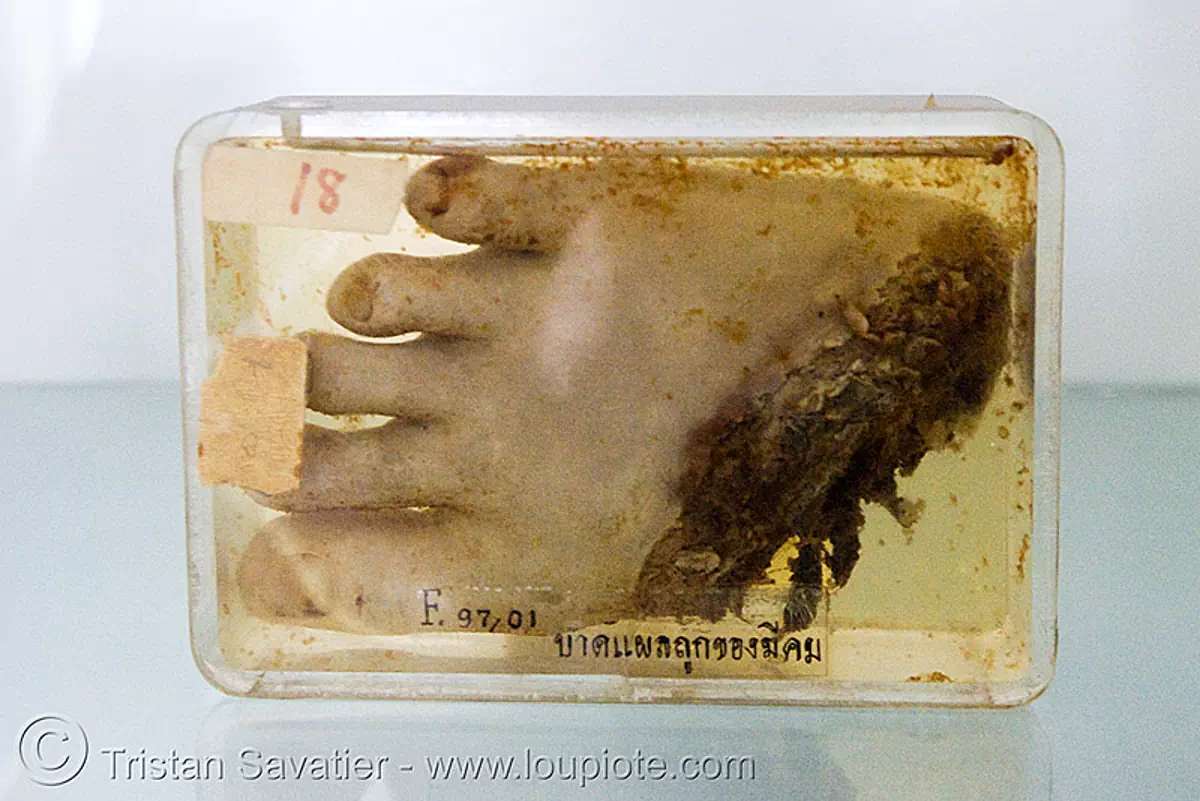 severed foot, preserved, forensic medicine museum, โรงพยาบาลศิริราช ...